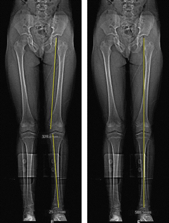Leg Length Discrepancy (LLD) - Pediatrics - Orthobullets
